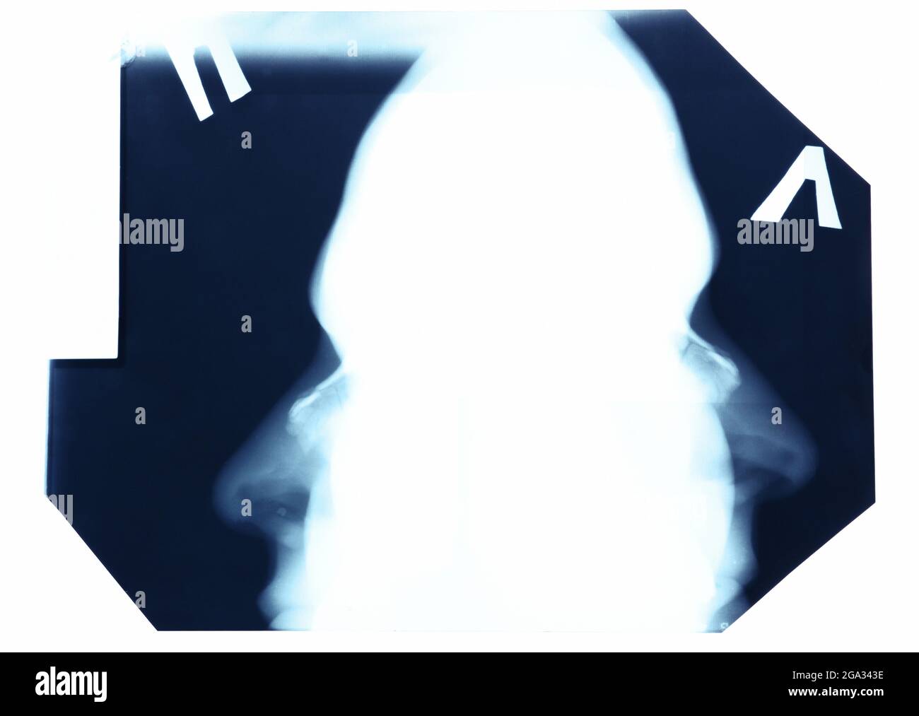 Human Joint X Ray Gray Background High Resolution Stock Photography and ...