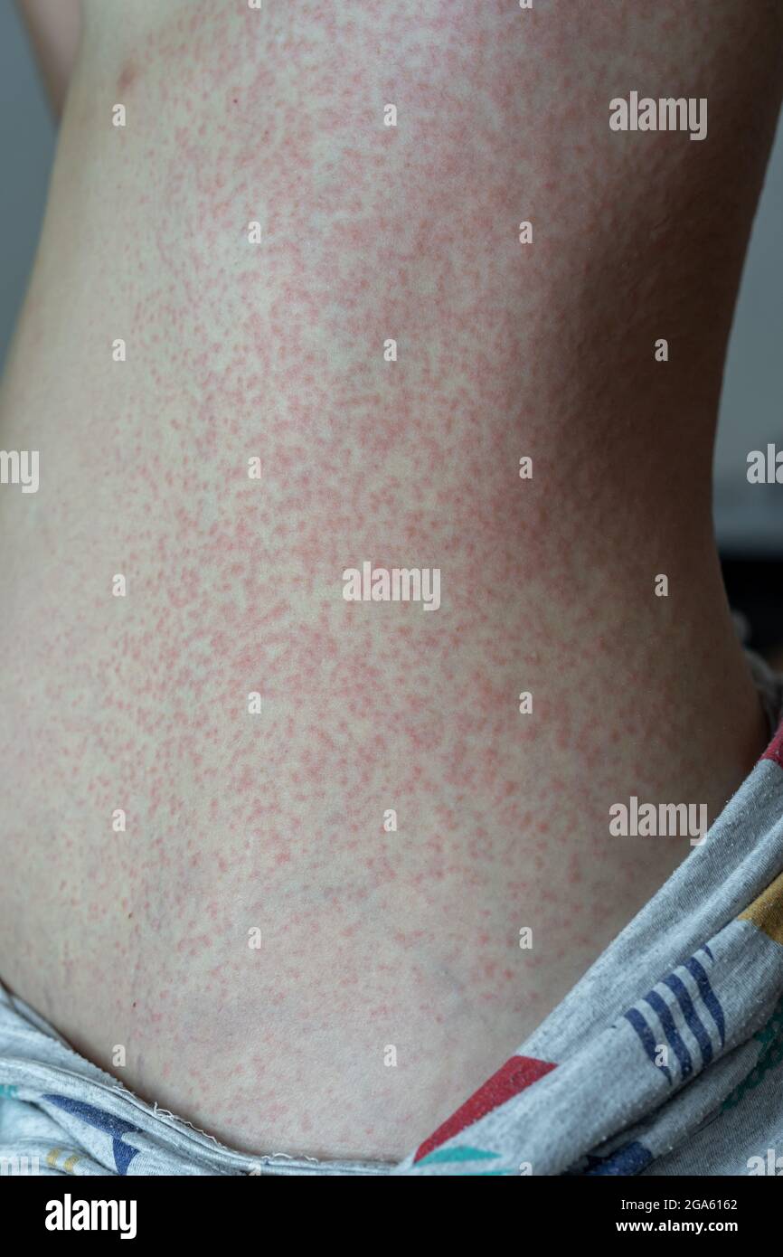 Vertical shot of a young male sitting with his back skin in red rash ...