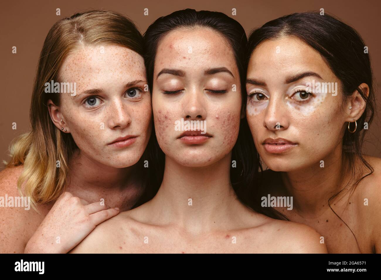 Woman having skin problems content. Close up of three women with unique ...