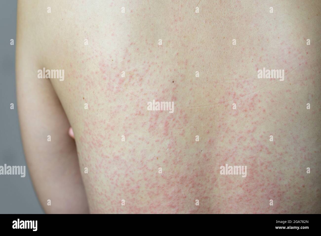 Closeup of a back of a person with dermatitis problem of rash Stock ...