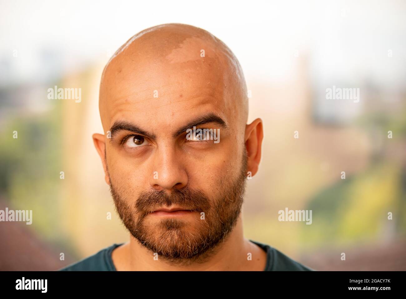 A tanned Caucasian Man with shaved head has a problem with the skin on ...