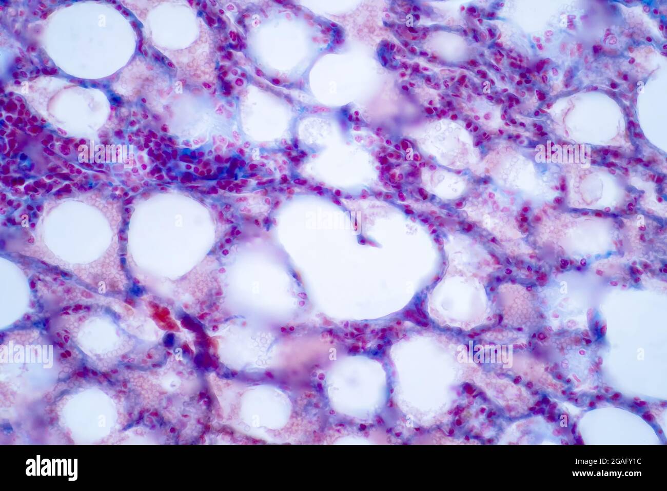 Human lung tissue, light micrograph Stock Photo - Alamy