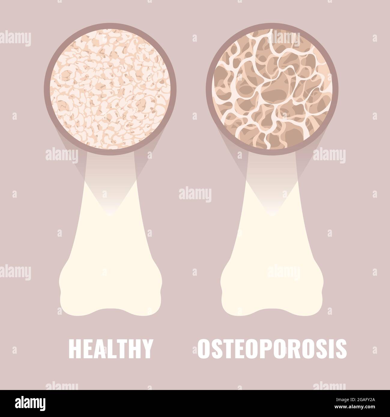 Bone Density Brittle High Resolution Stock Photography and Images - Alamy