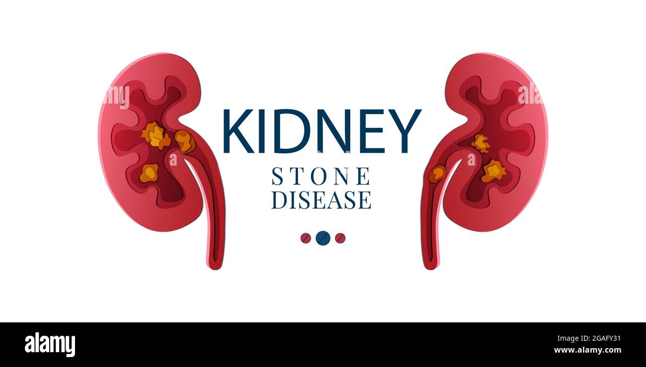 Kidney stone disease, conceptual illustration Stock Photo - Alamy