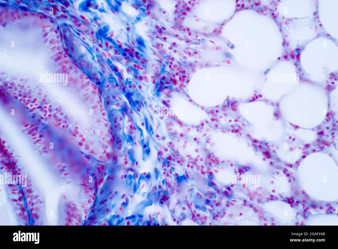 Human lung tissue, light micrograph Stock Photo - Alamy