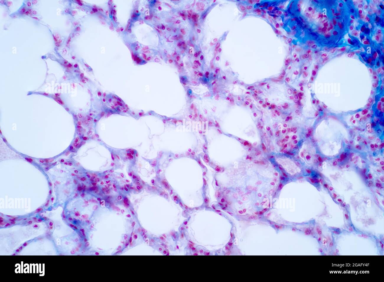 Lung tissue hi-res stock photography and images - Alamy