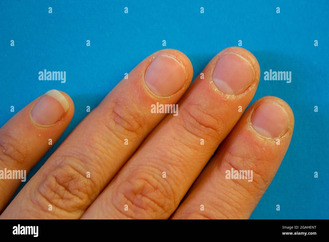 Close up of ugly nails on a hand Stock Photo - Alamy