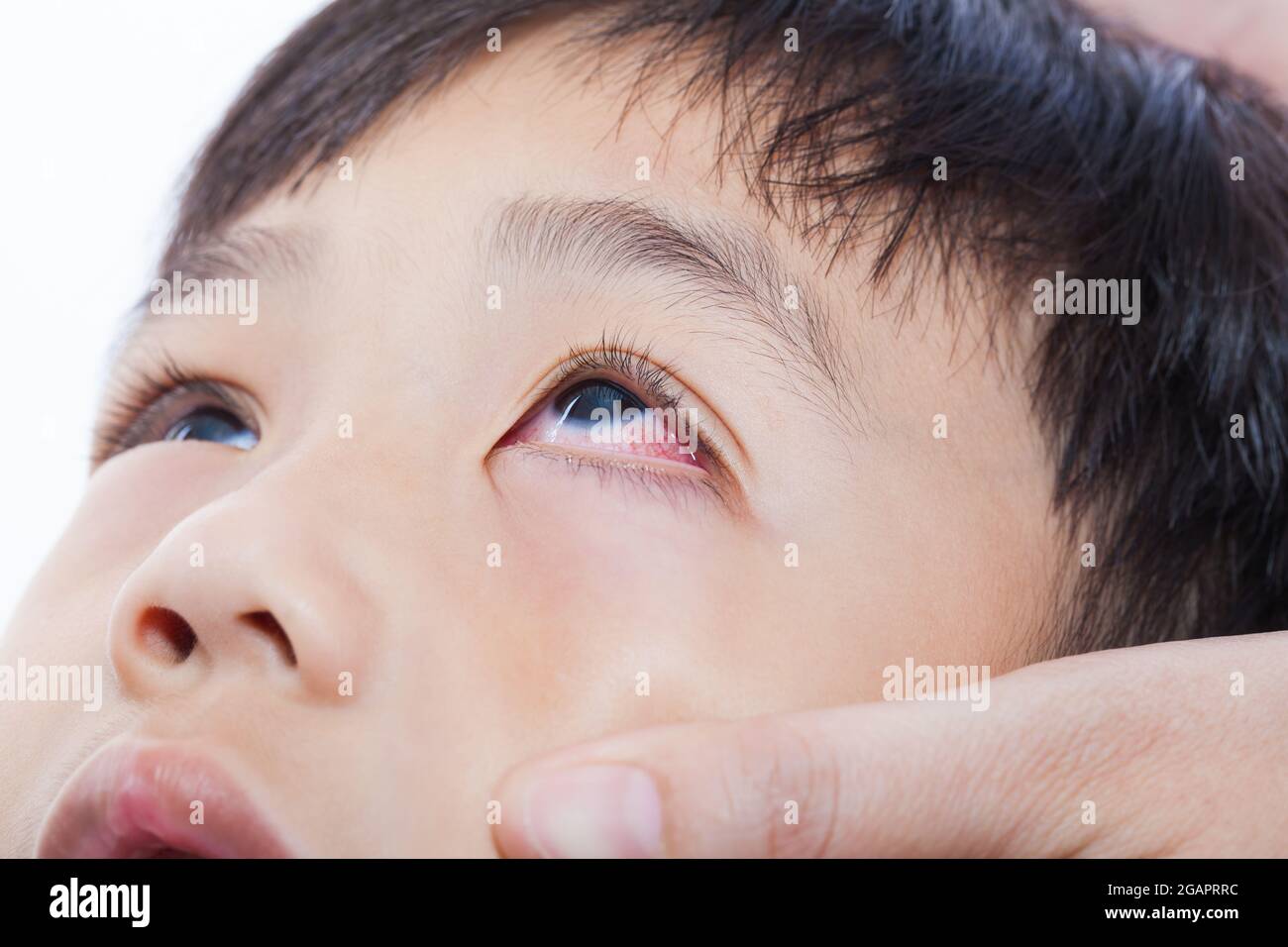 Closeup pinkeye (conjunctivitis) infection on a little asian (thai) boy ...