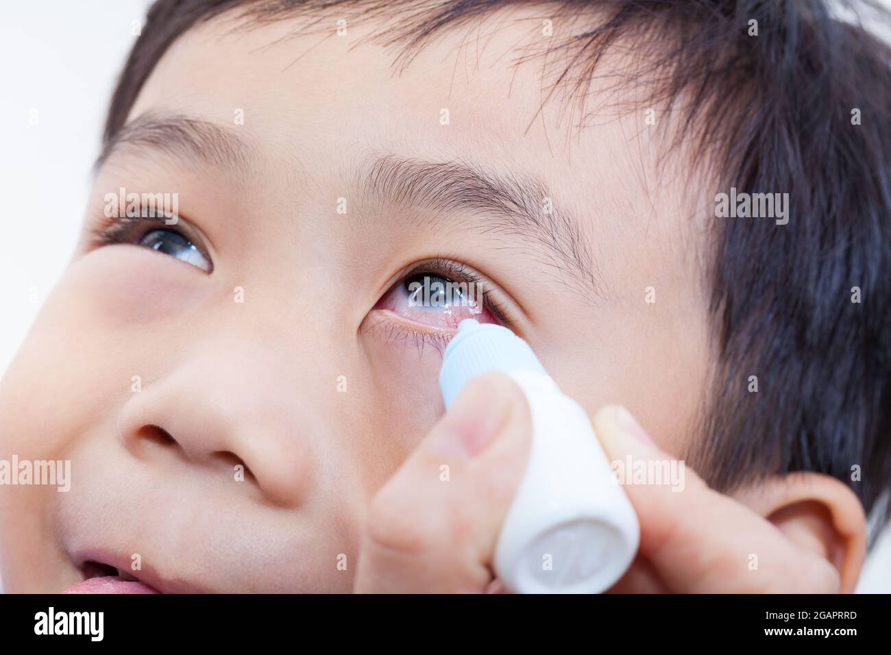 Closeup of parent pouring eye drops in eye her son (conjunctivitis ...