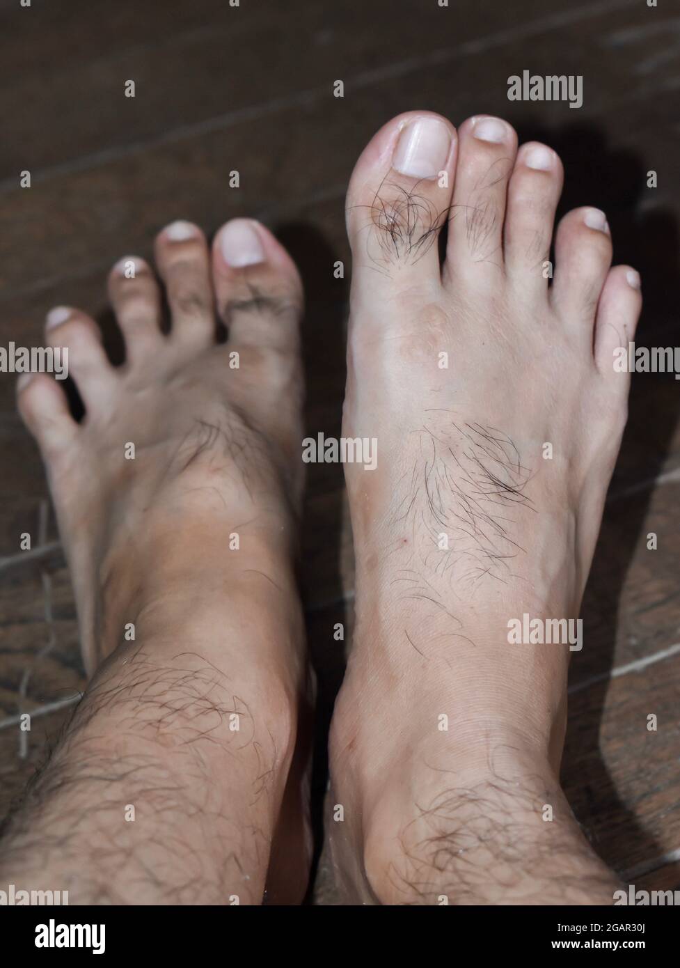 Concept of foot drop. Left foot is blurred. Foot drop is a gait ...