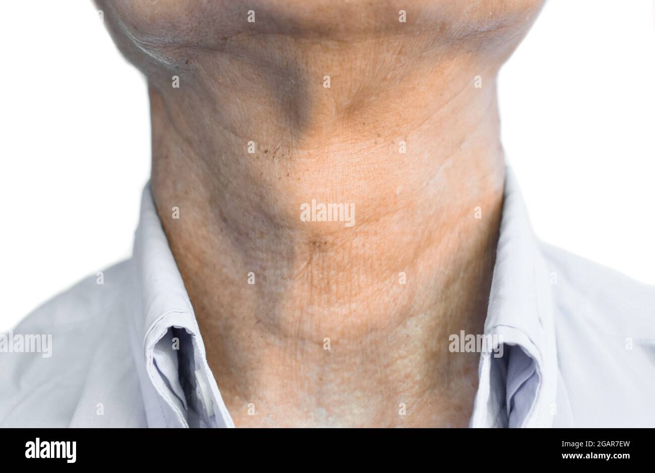 Aging skin folds or skin creases or wrinkles at neck of Southeast Asian ...