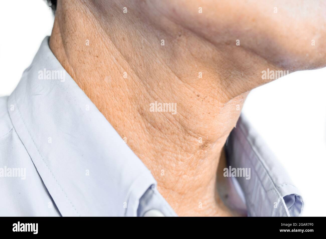 Aging skin folds or skin creases or wrinkles at neck of Southeast Asian ...
