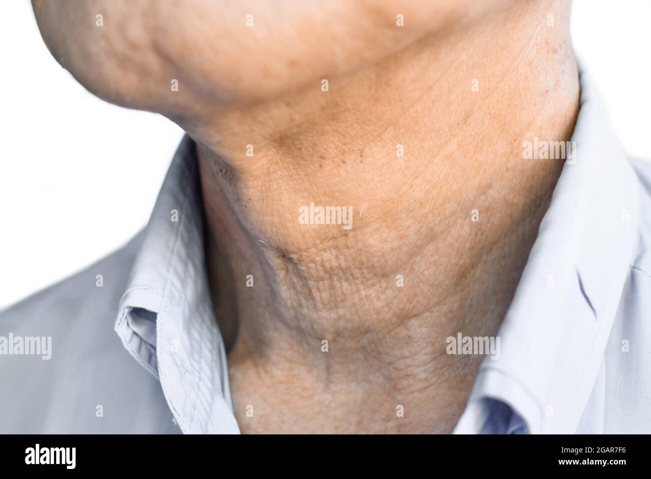 Aging skin folds or skin creases or wrinkles at neck of Southeast Asian ...