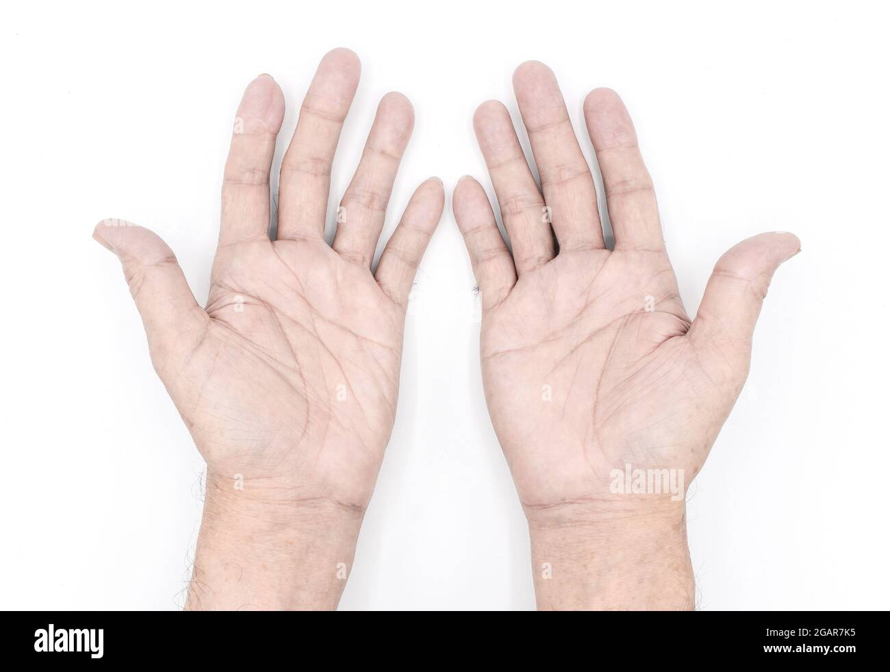 Anemic pallor hi-res stock photography and images - Alamy