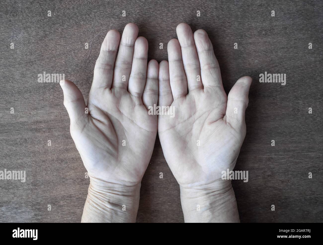 Pale palmar surface of both hands. Anaemic hands of Asian, Chinese ...