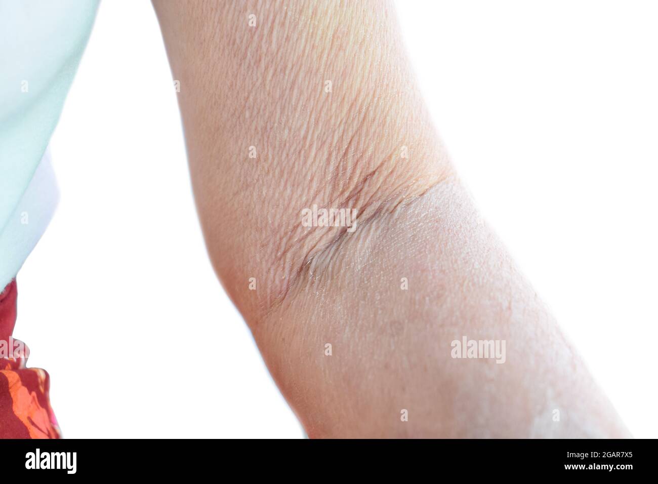 Aging skin folds or skin creases or wrinkles at arm and forearm of ...