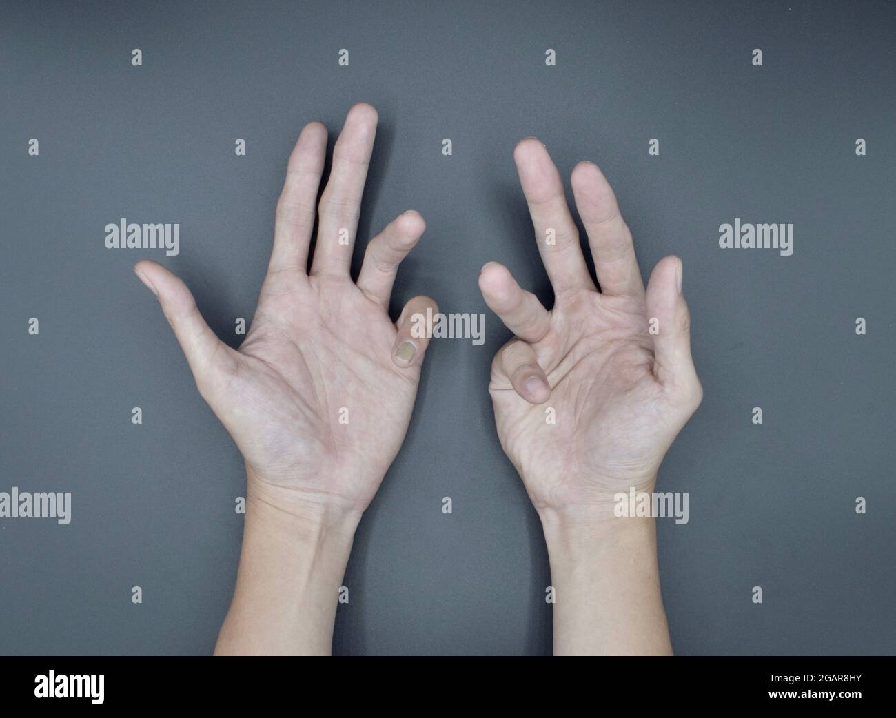 Bilateral Dupuytren’s contracture in Asian young man. Bilateral hand ...