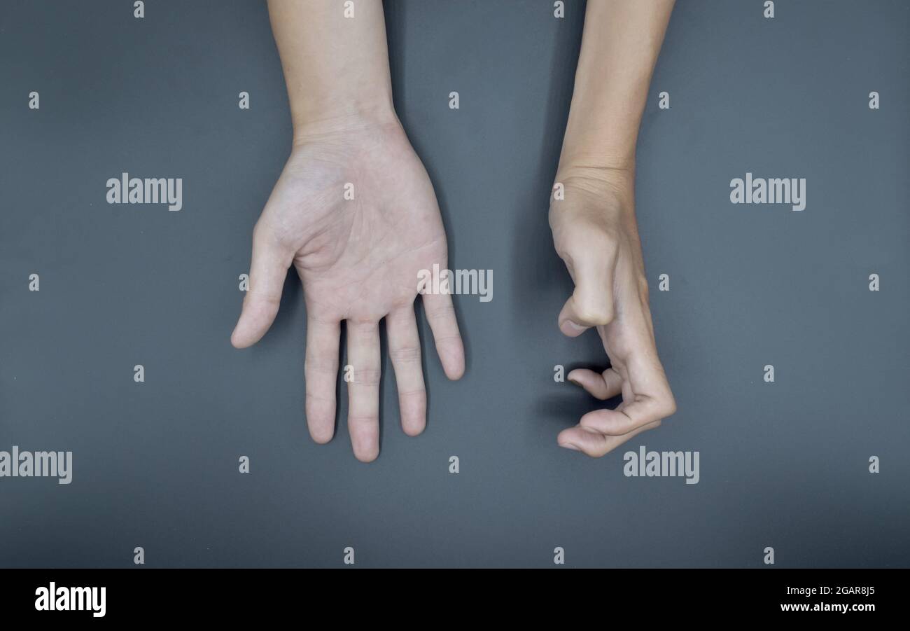 Ulnar nerve injury hi-res stock photography and images - Alamy