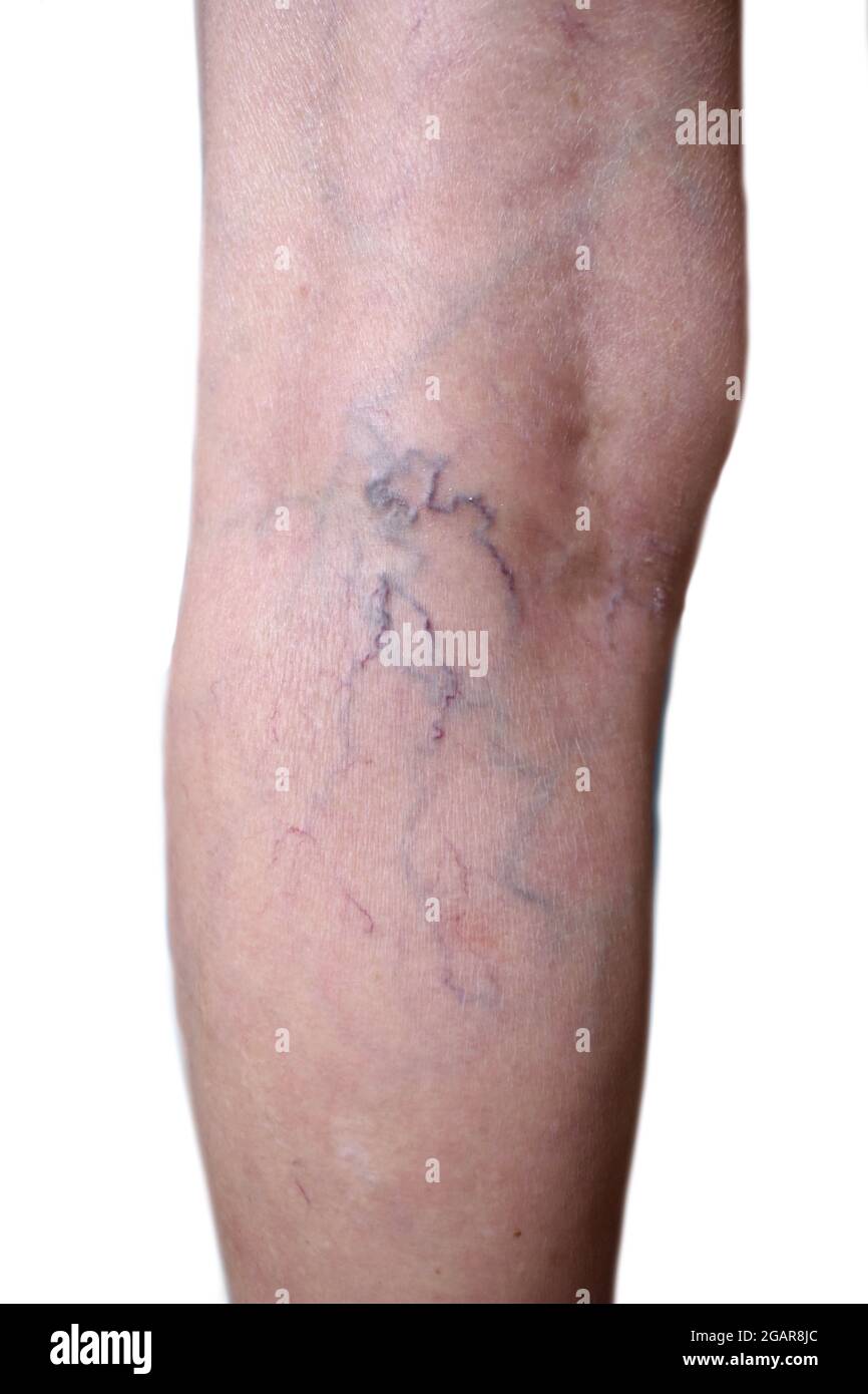 Southeast Asian, Myanmar old woman’s leg. Skin creases, loosen and thin ...