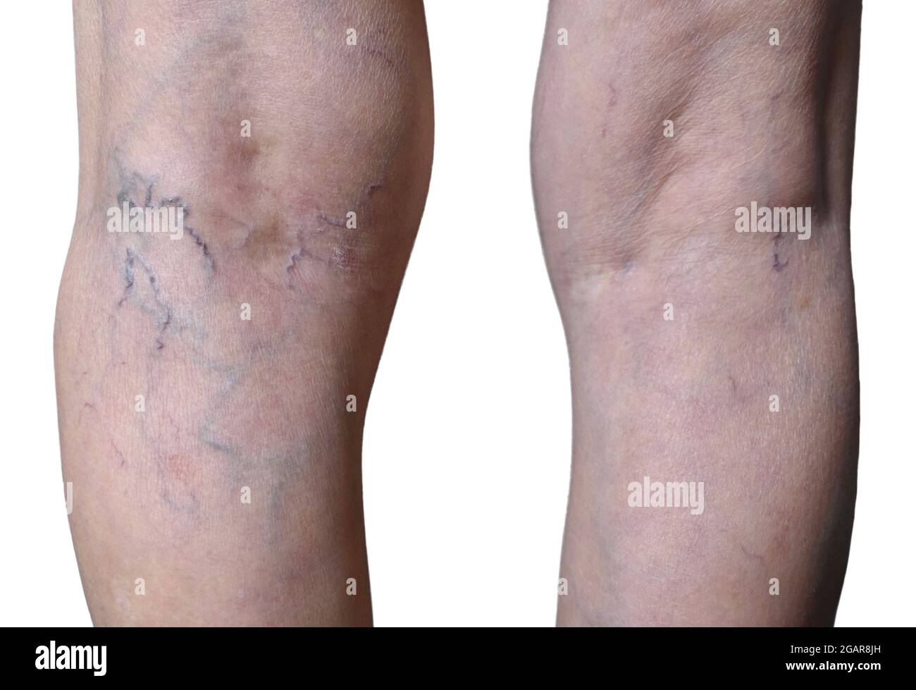 Southeast Asian, Myanmar old woman’s legs. Skin creases, loosen and ...