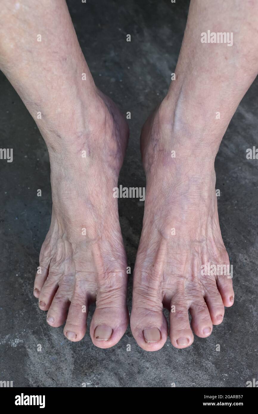 Wrinkled toes hi-res stock photography and images - Alamy