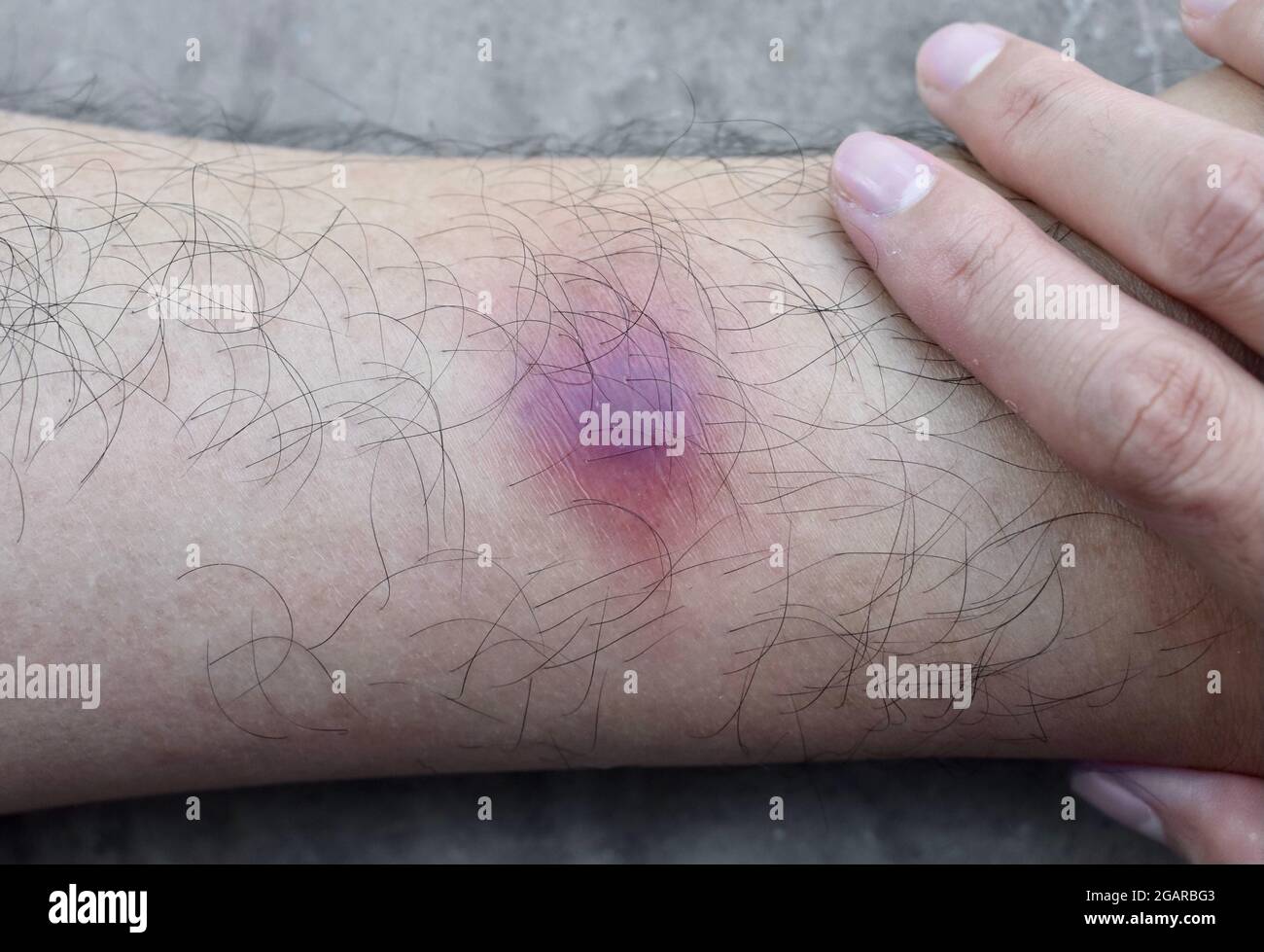 Bruise leg hi-res stock photography and images - Alamy