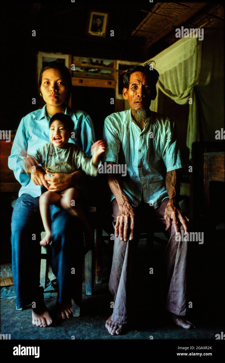 Quyen is four. She has microcephalia. Quen’s father, Nyguyen Van Quach ...