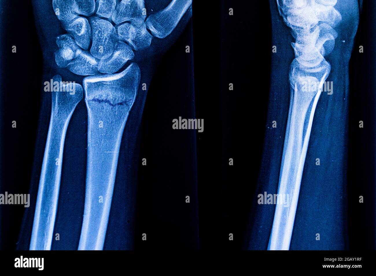 Radiography examination of radius fracture. X-ray human arm. X-ray of ...