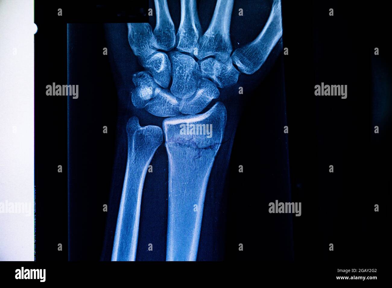 Radiography examination of radius fracture. X-ray human arm. X-ray of ...