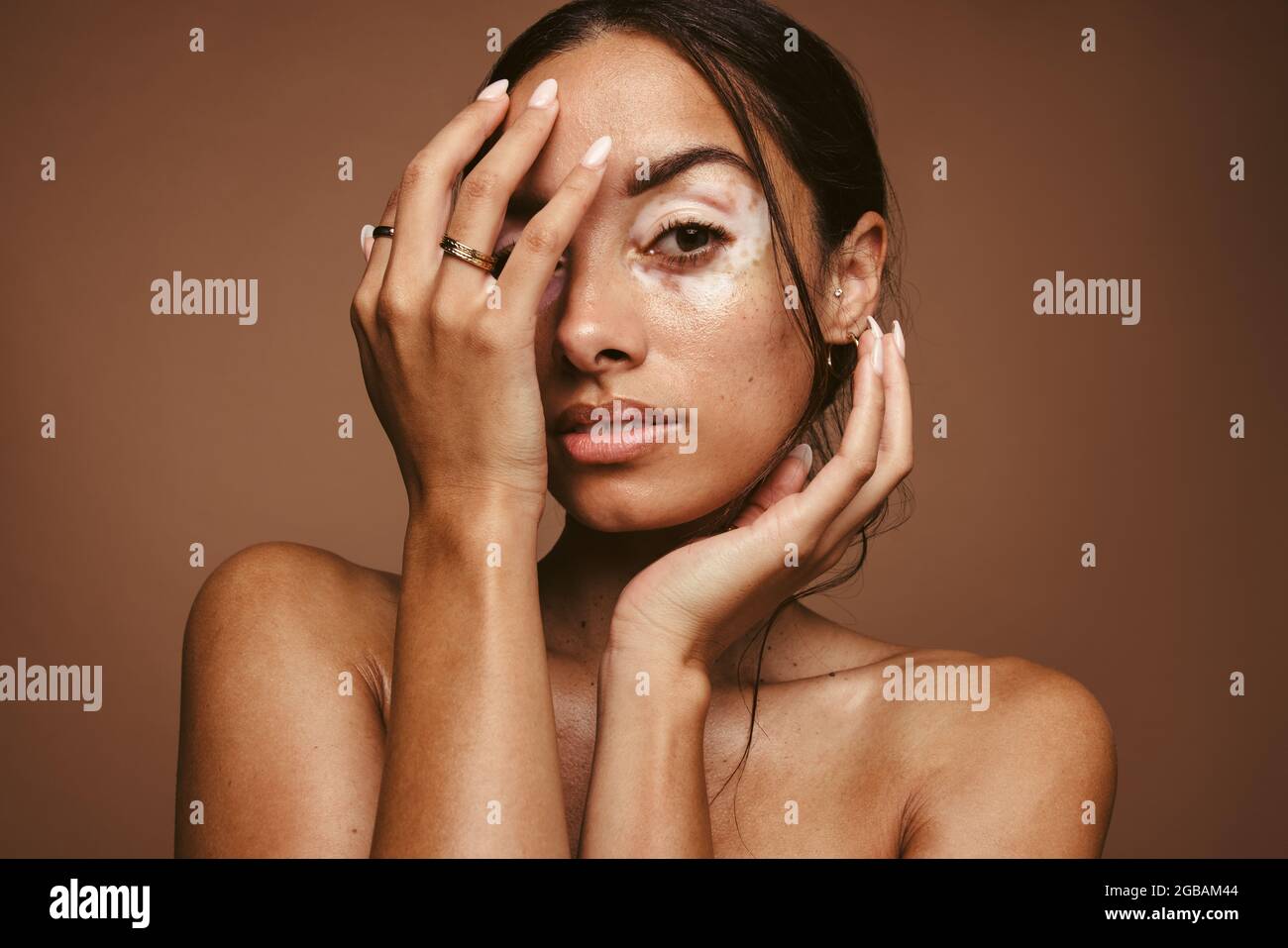 Vitiligo skin condition hi-res stock photography and images - Alamy