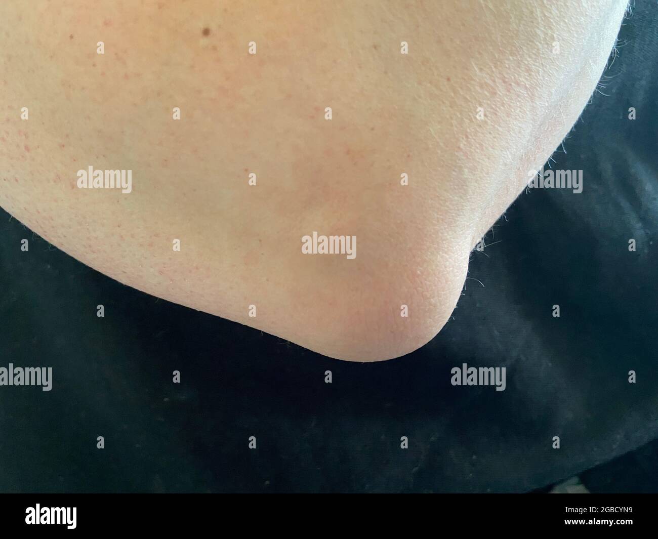 Popeye Elbow Swelling