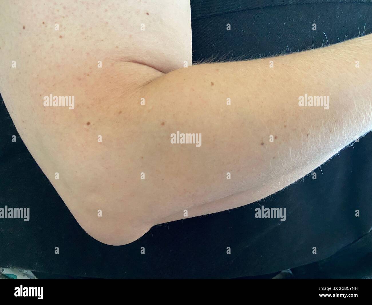 olecranon bursitis is sometimes called “Popeye’s elbow.” Bursitis is a ...