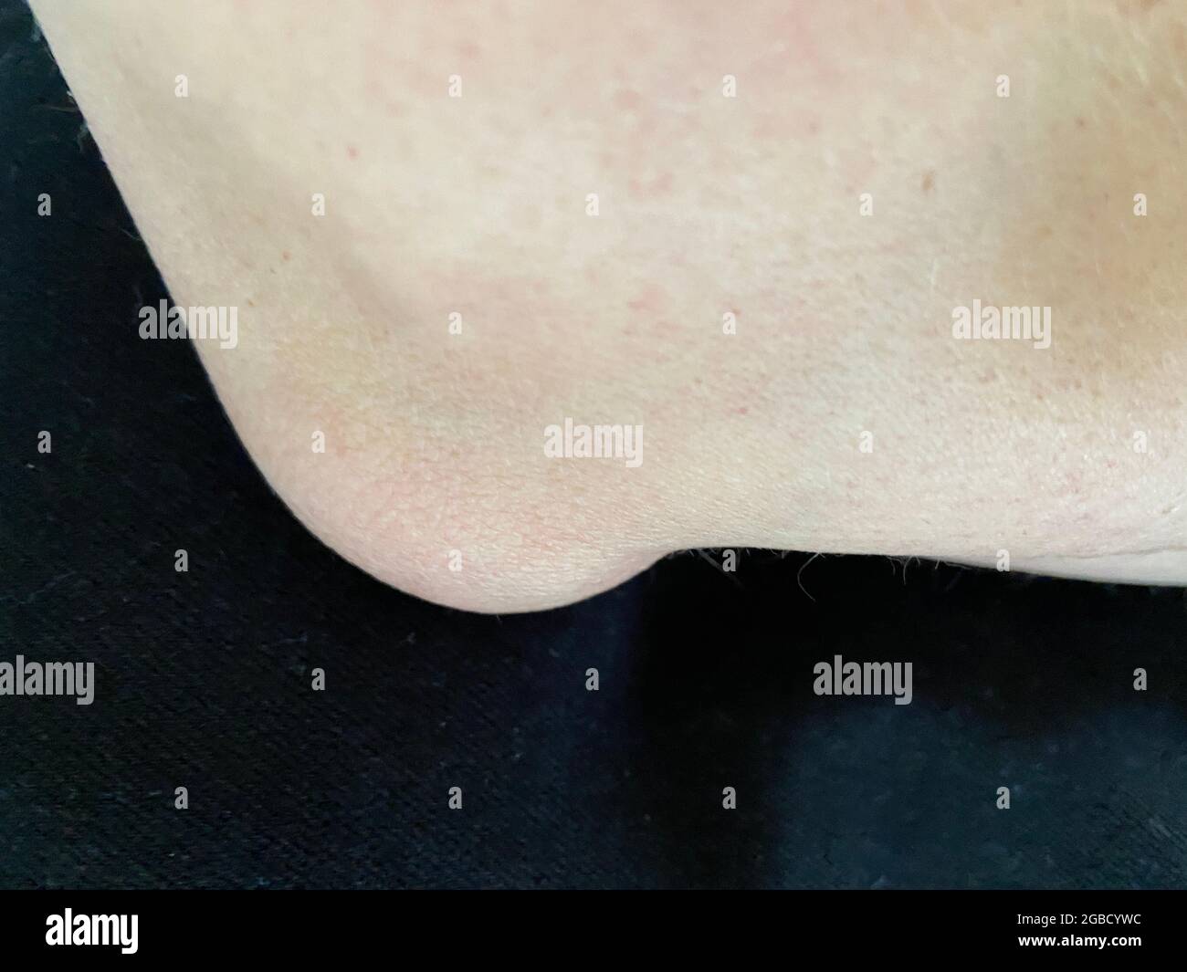 Popeye Elbow Swelling