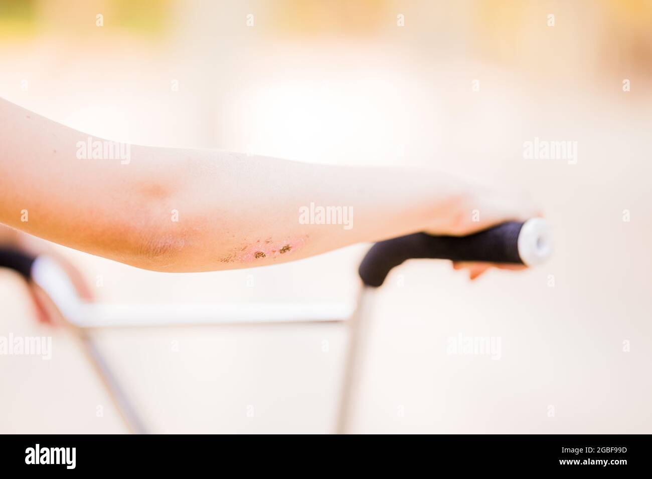 Skin abrasion hi-res stock photography and images - Alamy
