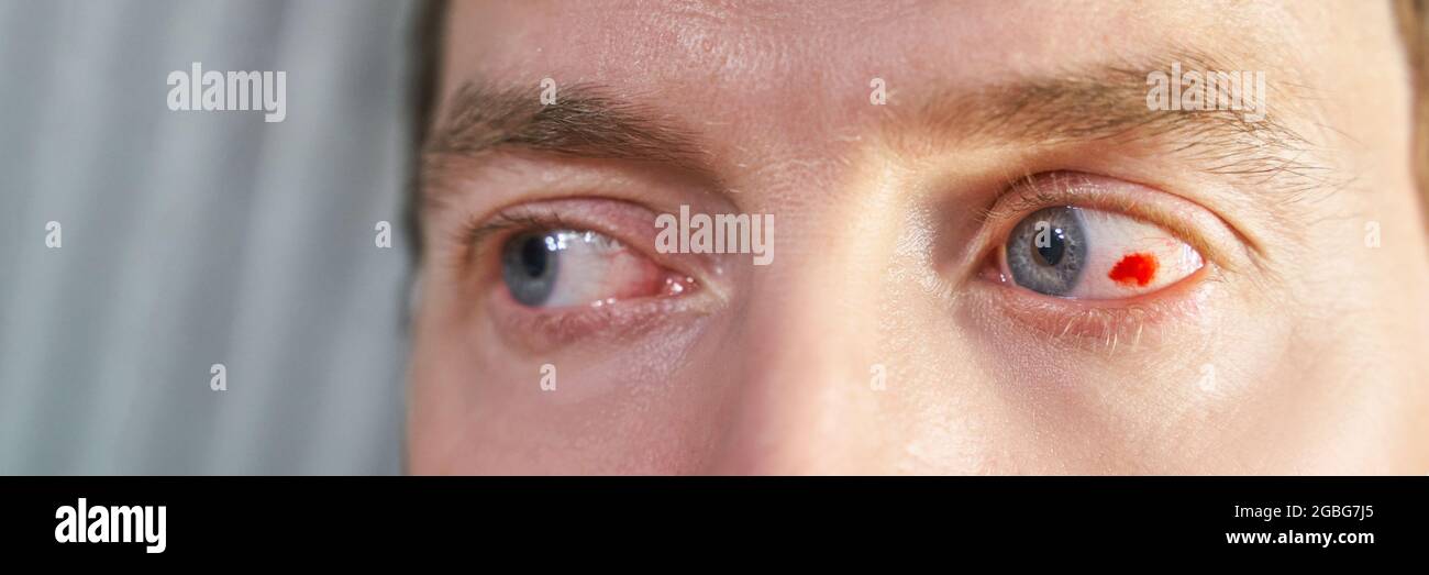 Man damaged eye ball. Conjunctivitis blood. Allergy ophtalmology test ...