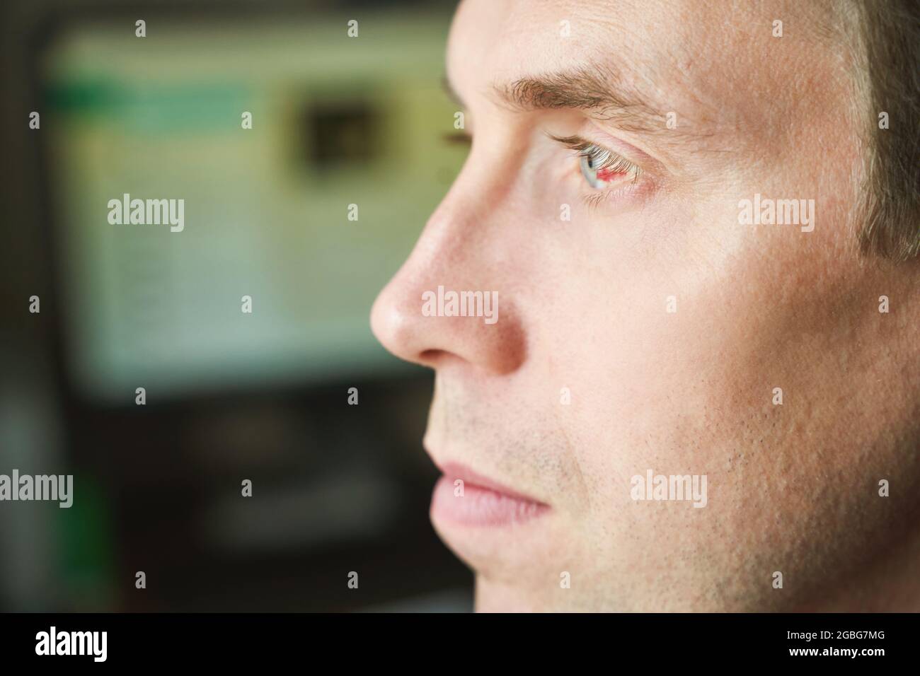 Man damaged eye ball. Conjunctivitis blood. Allergy ophtalmology test ...