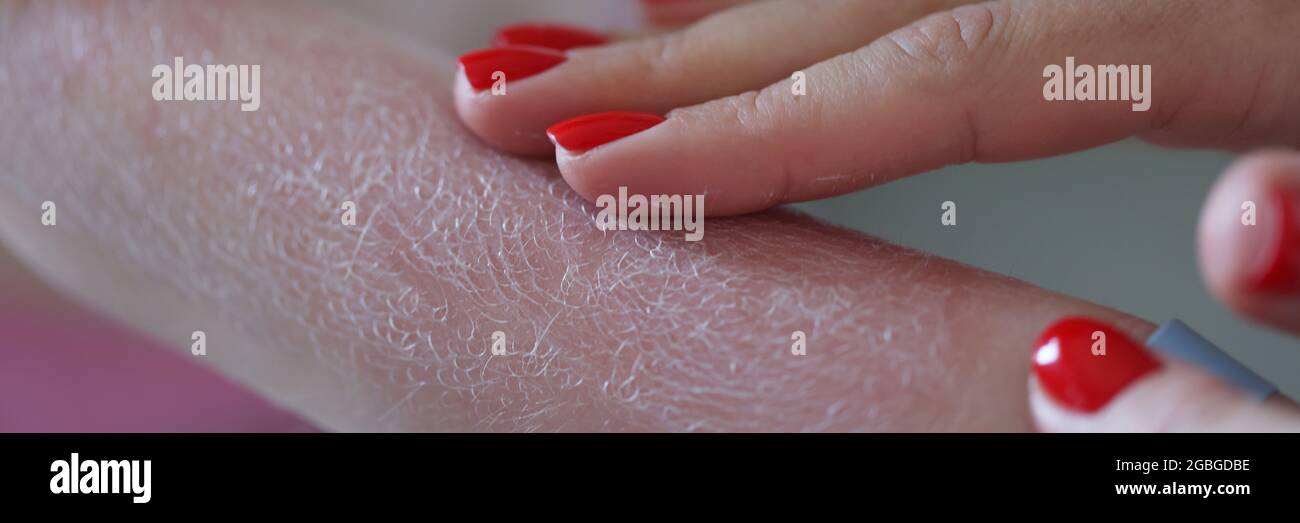 Sunburn cream is applied to the child red hand Stock Photo - Alamy