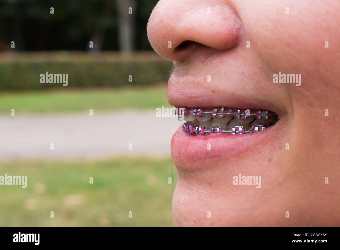 Teeth with braces, female Teeth outdoor Stock Photo - Alamy