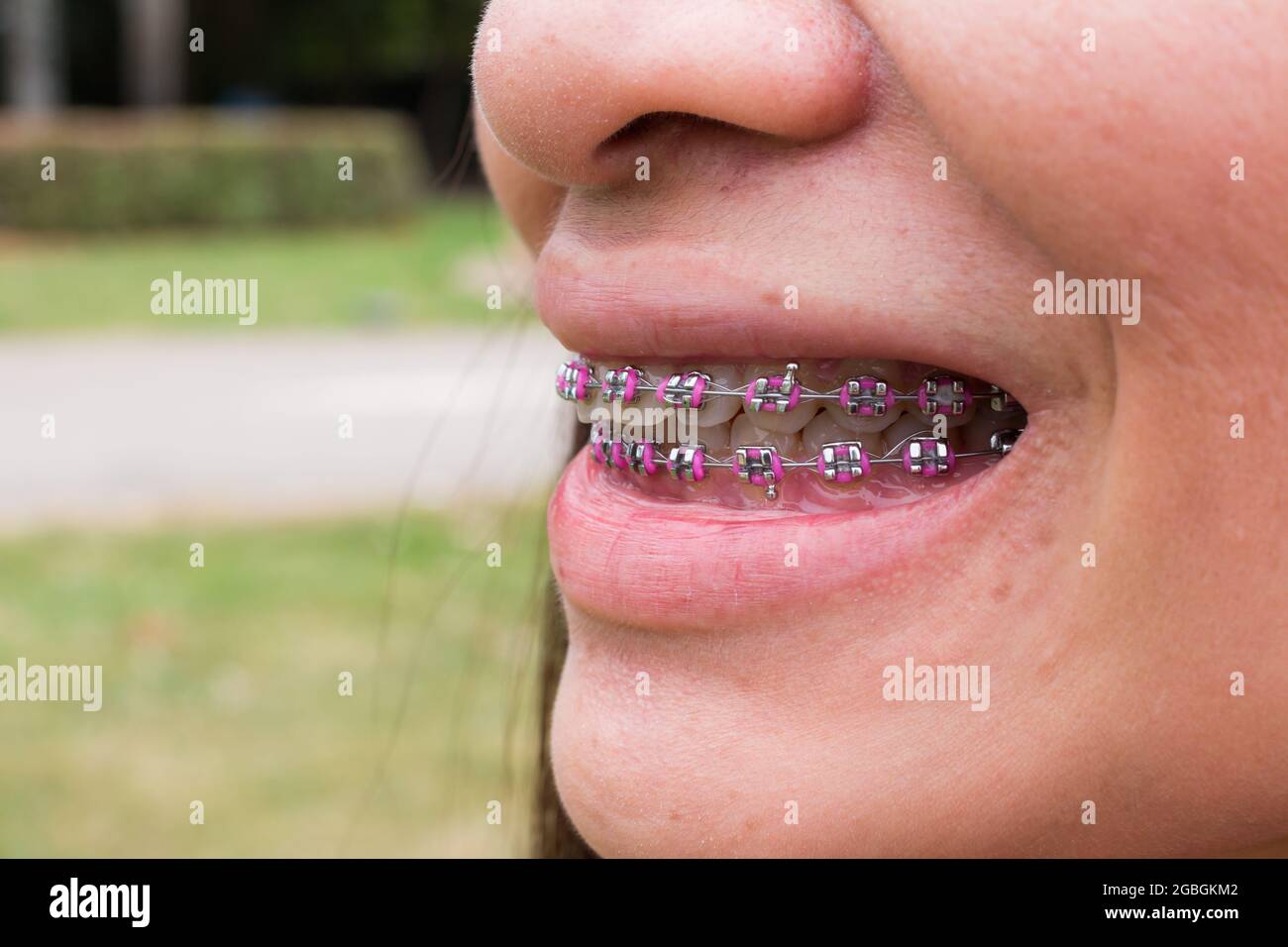 Teeth with braces, female Teeth outdoor Stock Photo - Alamy