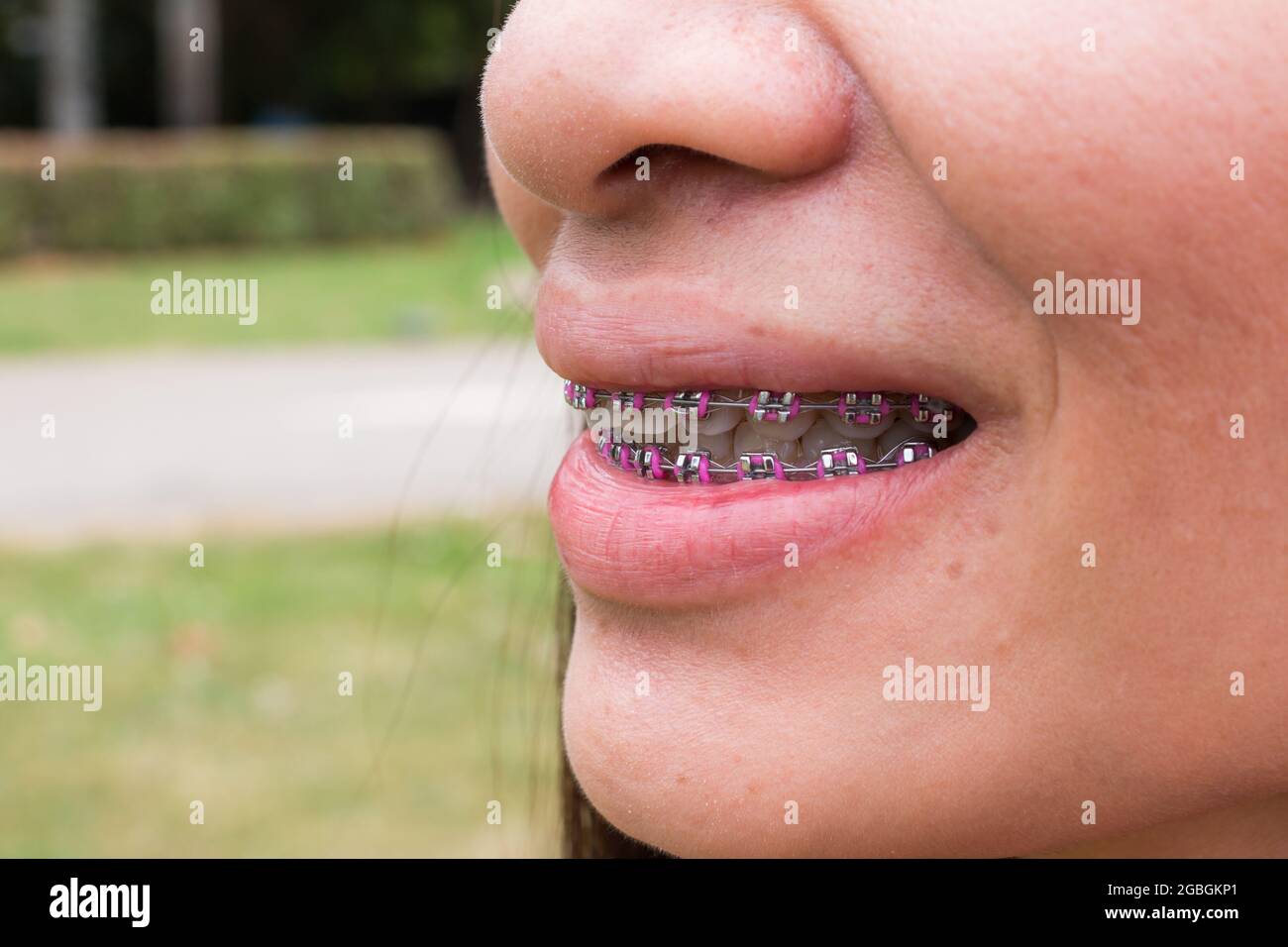 Teeth with braces, female Teeth outdoor Stock Photo - Alamy