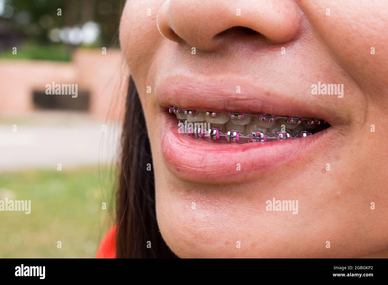 Teeth with braces, female Teeth outdoor Stock Photo - Alamy