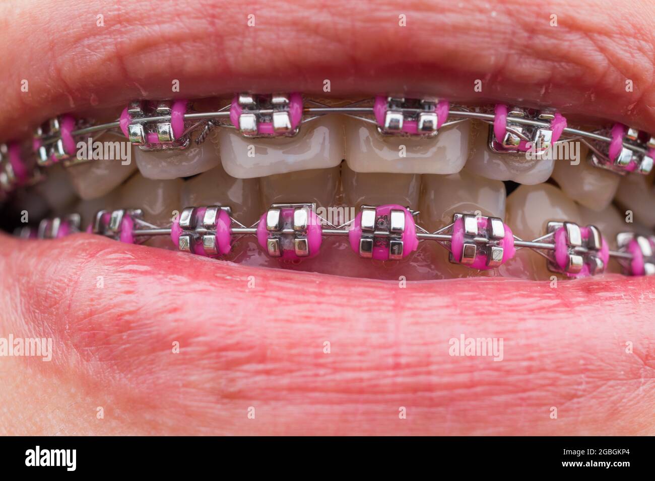 Light Pink Braces