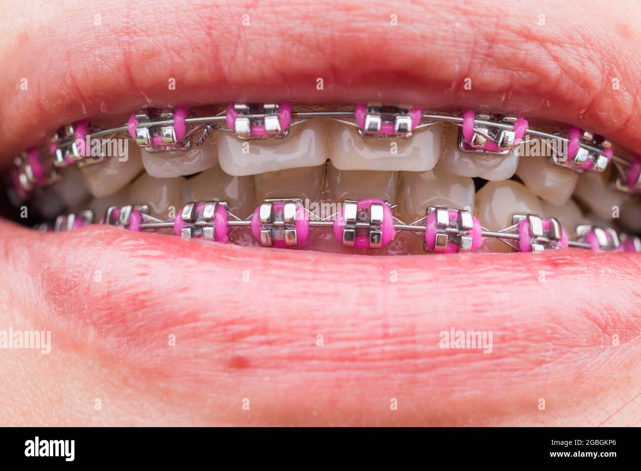 Teeth with braces, female Teeth outdoor Stock Photo - Alamy