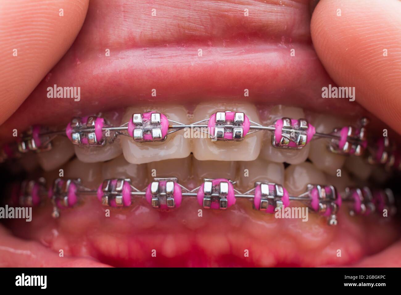 Teeth with braces, female Teeth outdoor Stock Photo - Alamy