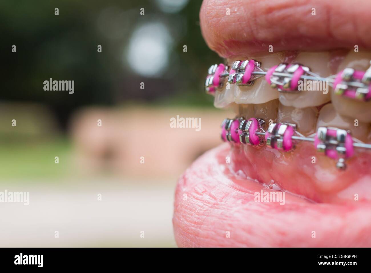 Teeth with braces, female Teeth outdoor Stock Photo - Alamy