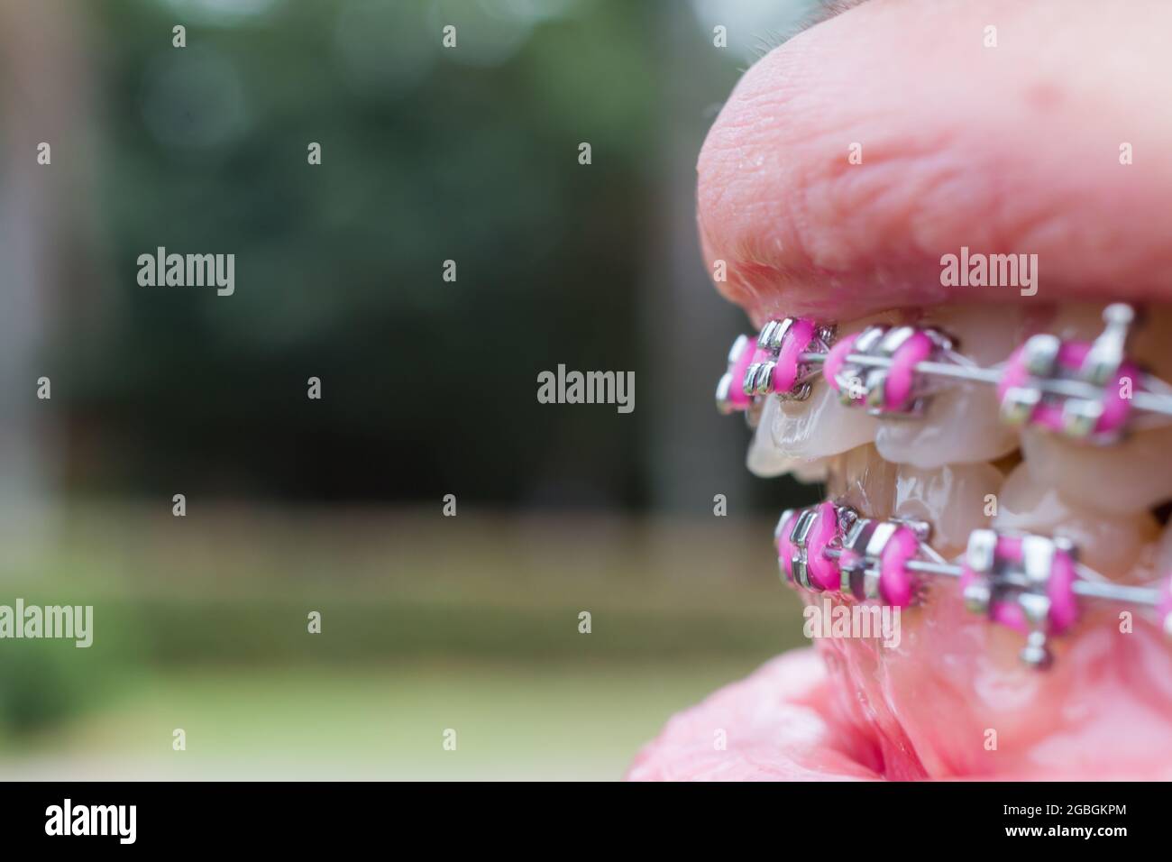 Teeth with braces, female Teeth outdoor Stock Photo - Alamy