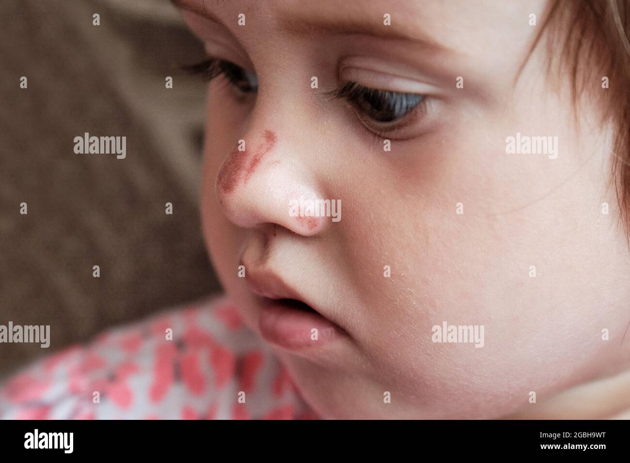 Portrait of a sad little girl with a scratched nose, close-up ...