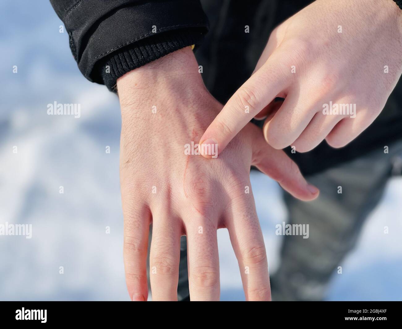 scratch on a hand, close up Stock Photo - Alamy