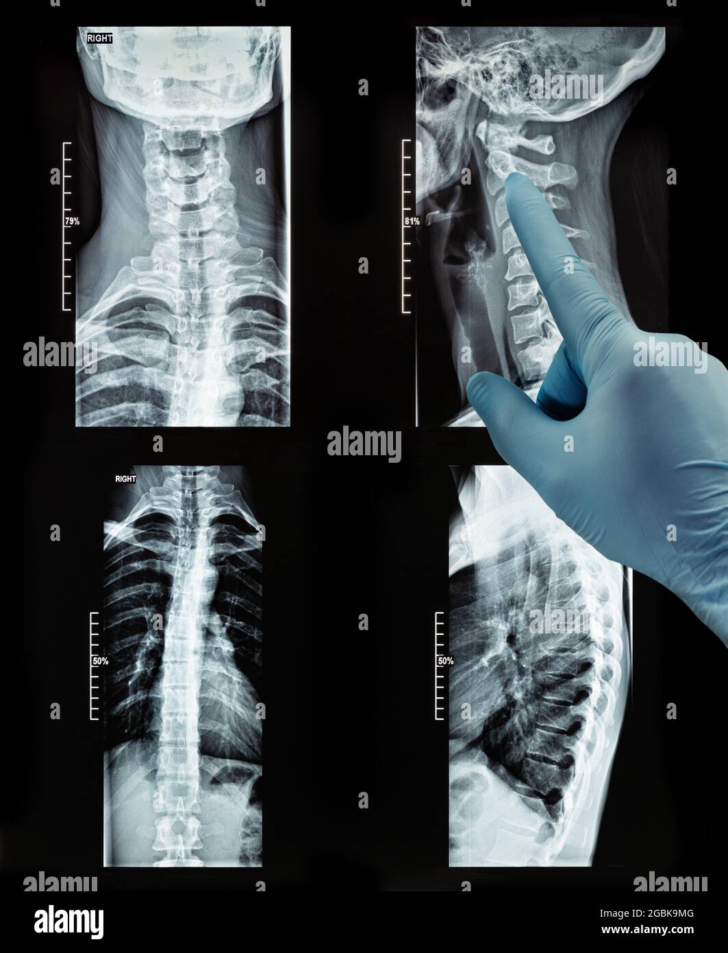Radiography of a female spine with severe scoliosis mri scan hand in ...
