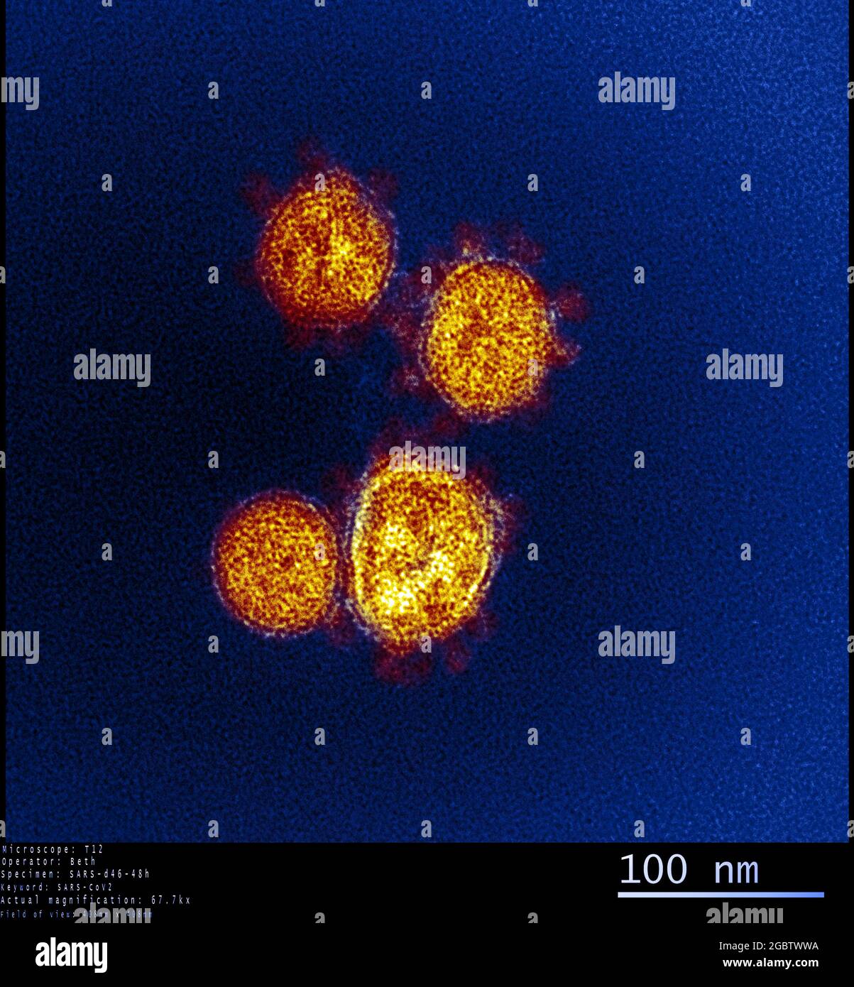 Novel Coronavirus SARS-CoV-2 This transmission electron microscope ...